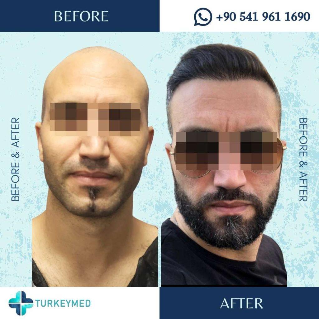 Hair Transplant Results Timeline Of Hair Growth Turkeymed