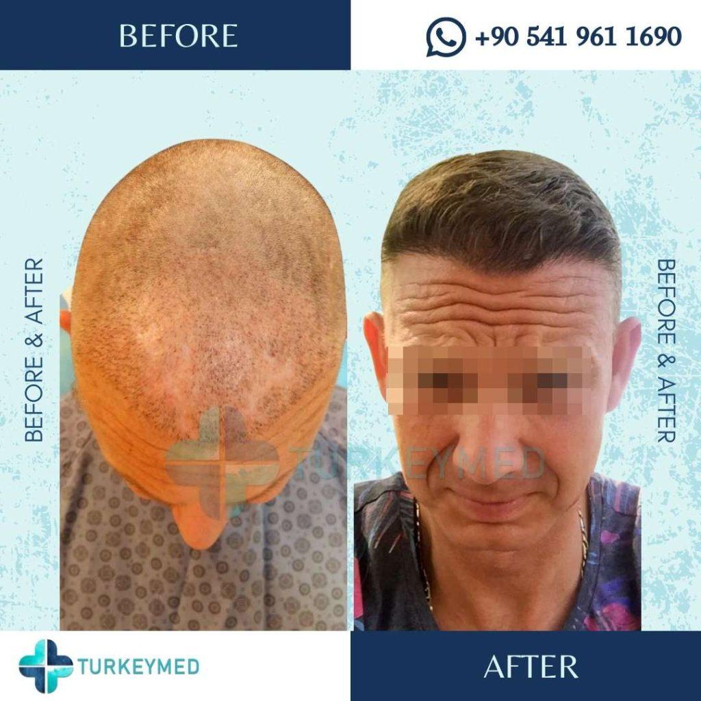 Hair Transplant Results Timeline Of Hair Growth Turkeymed