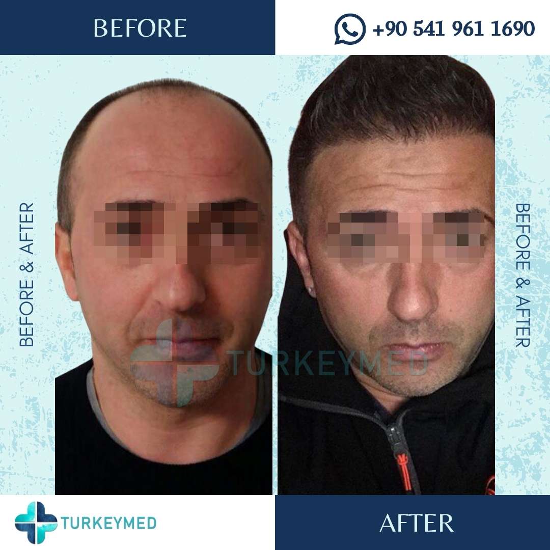 Hair Transplant Results Timeline Of Hair Growth Turkeymed