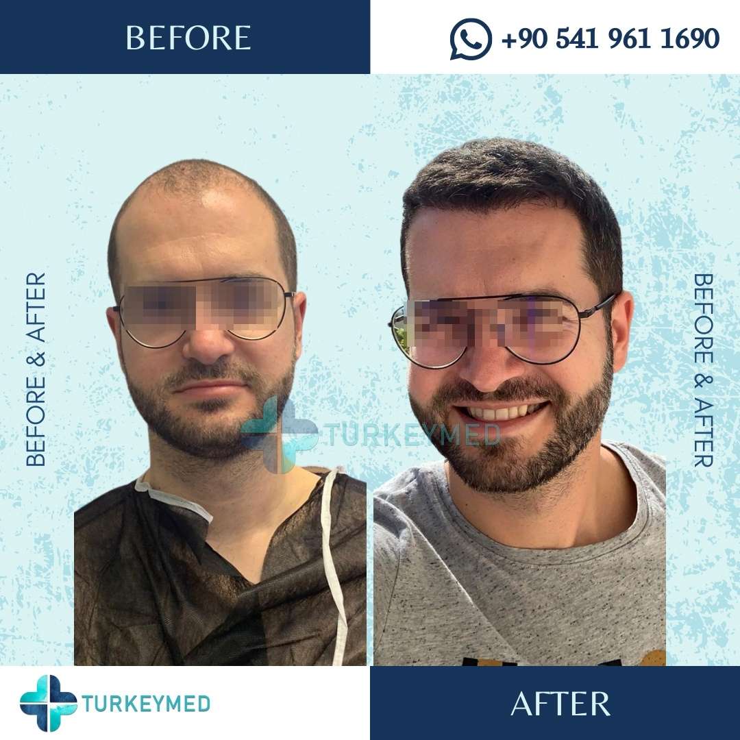 Hair Transplant Results Timeline Of Hair Growth Turkeymed