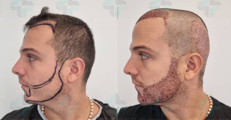 Turkeymed - Hair Transplant & Dental Treatments