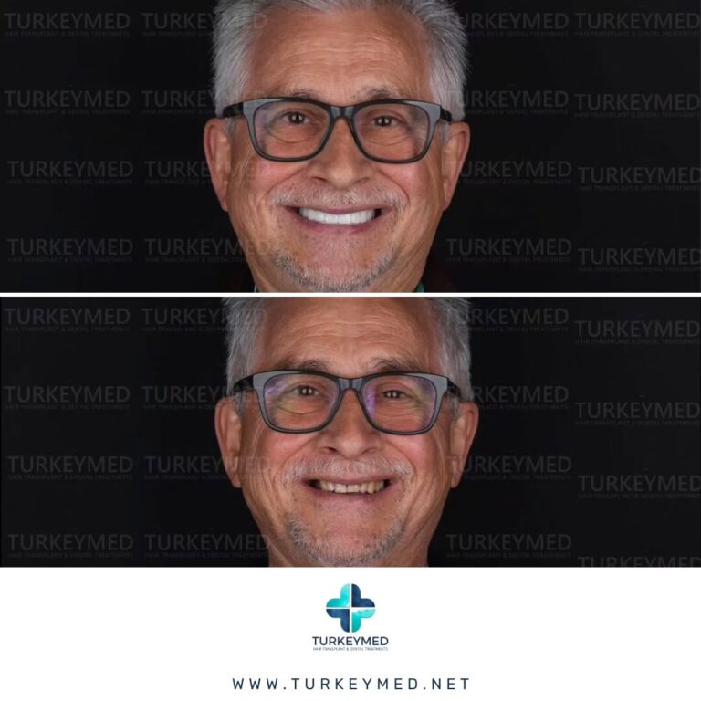 Turkeymed - Hair Transplant & Dental Treatments