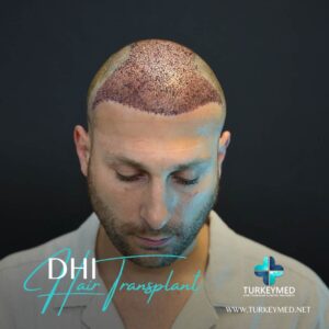Turkeymed - Hair Transplant & Dental Treatments