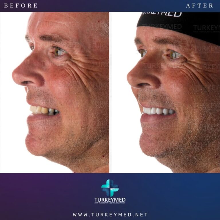 Turkeymed - Hair Transplant & Dental Treatments