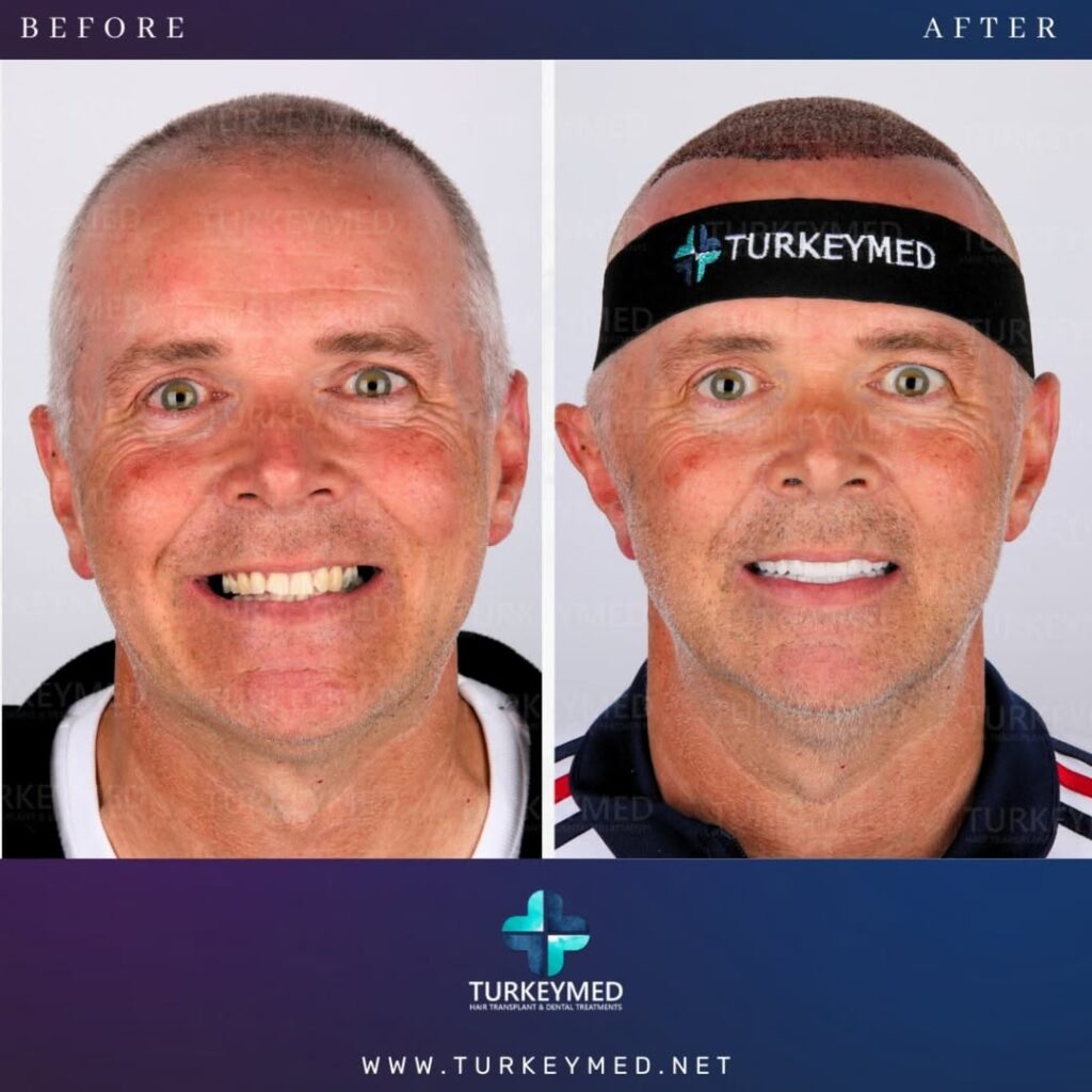 Turkeymed - Hair Transplant & Dental Treatments