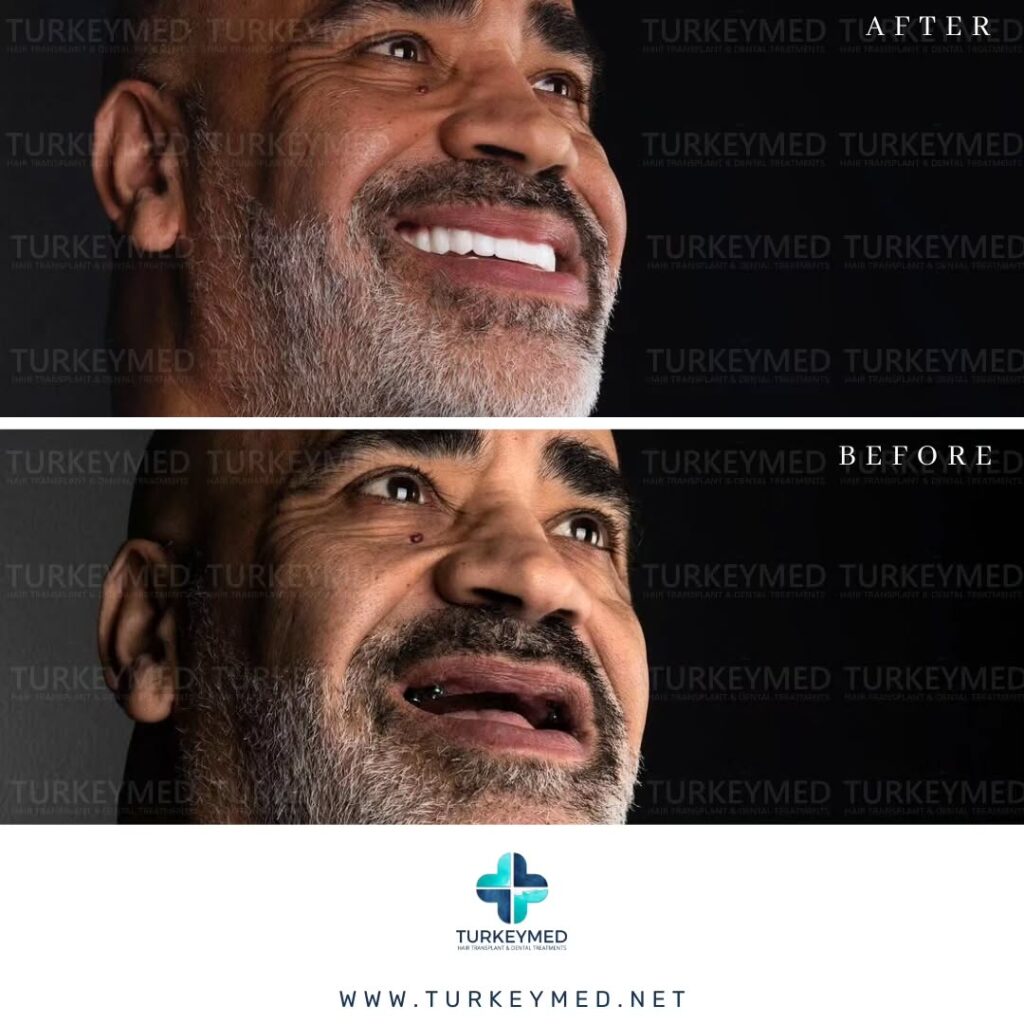 Turkeymed - Hair Transplant & Dental Treatments